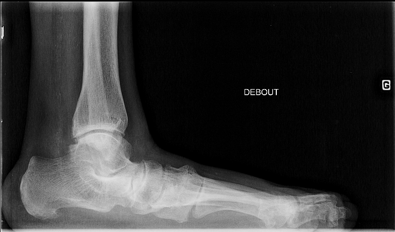 Pied plat valgus :: Dr Jean-Baptiste GROSS, Chirurgie Mini-Invasive et ...